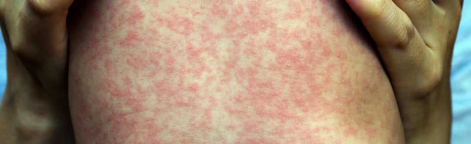 Ontario measles case count exceeds 800 total infections, 155 new since ...